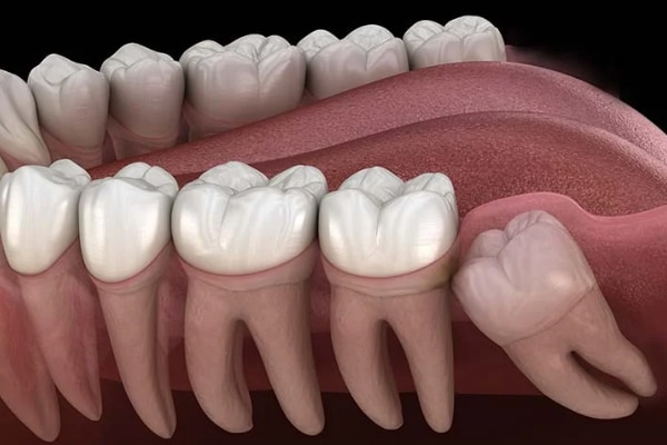 Tooth Extraction › Anbu Dental Clinic